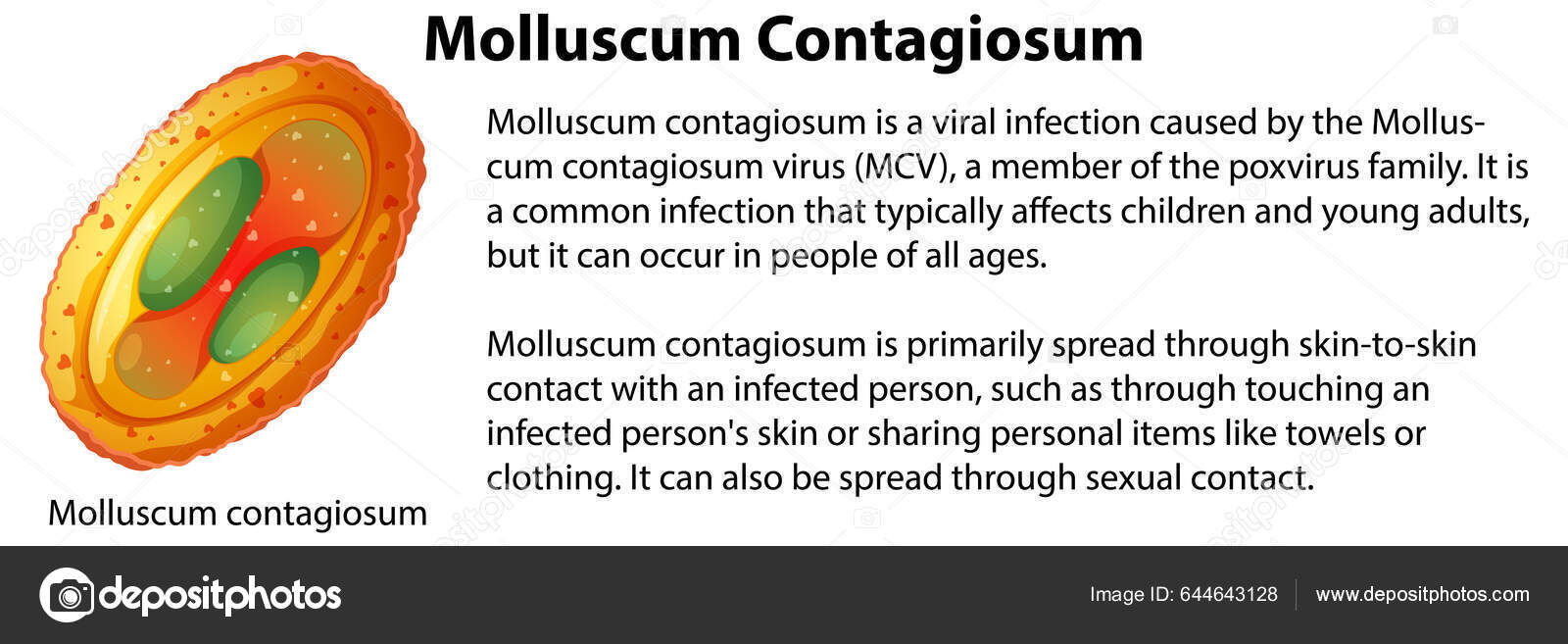 Molusco Contagioso Con Ilustración Explicativa Vector de stock ...