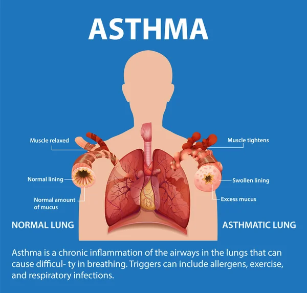 Infografía ilustrada que compara los pulmones humanos en condiciones ...