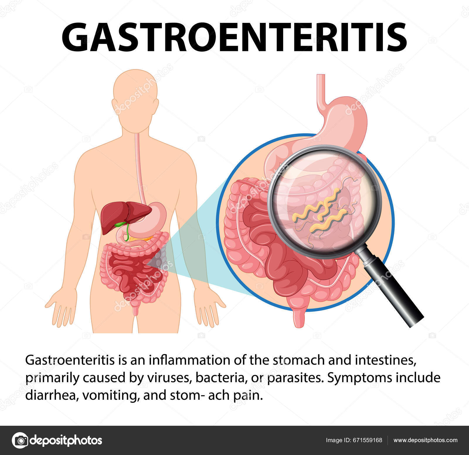 Una Infografía Que Ilustra Gastroenteritis Sus Causas Síntomas Vector de stock por ...
