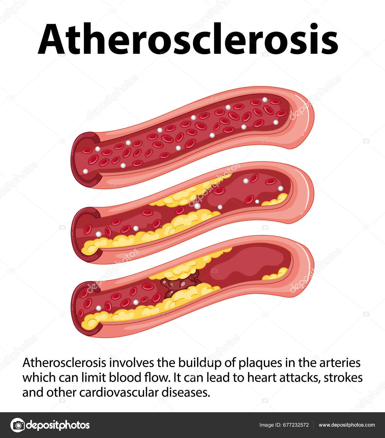 Infografía Sobre Los Riesgos Para Salud Cardiaca Las Enfermedades ...