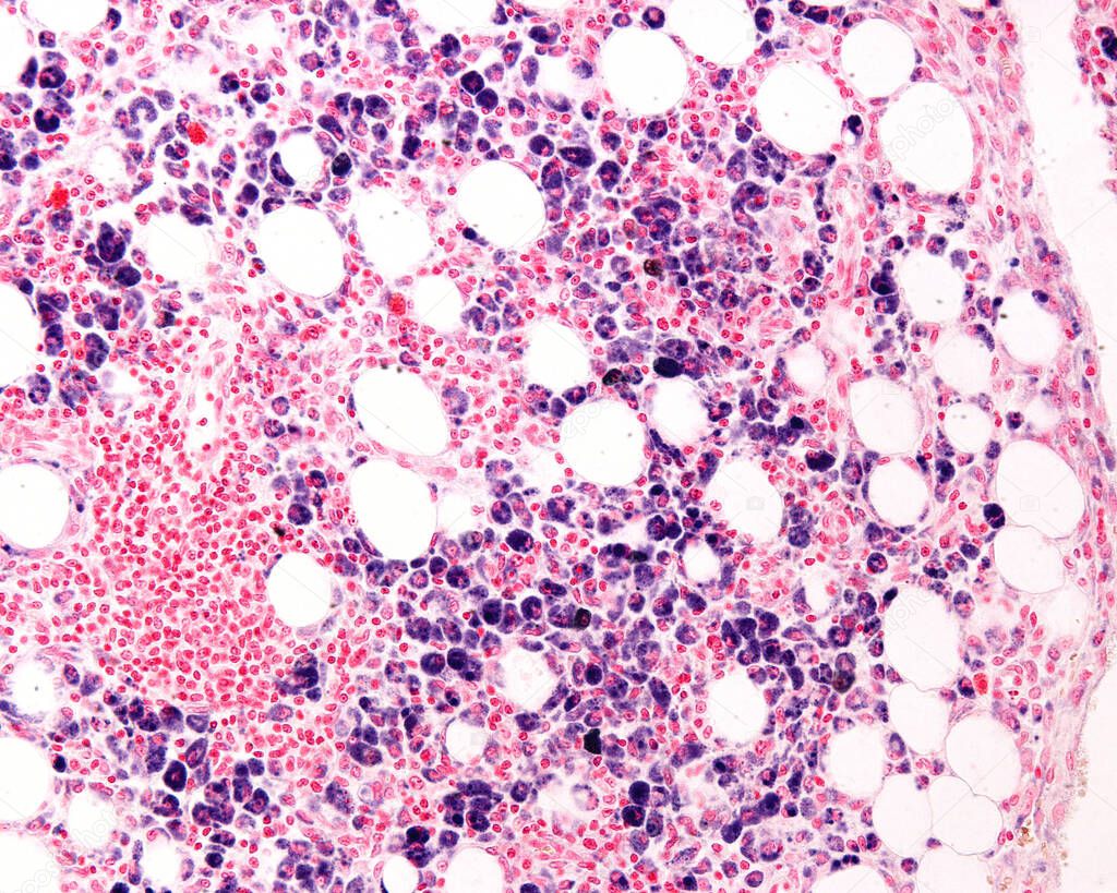 Los macrófagos de una zona de inflamación fuertemente marcada con azul ...