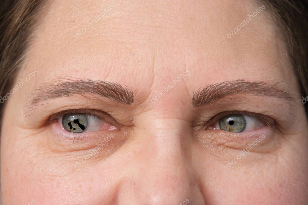 congenital colaboma of iris, pear-shaped black spot, chromosomal ...