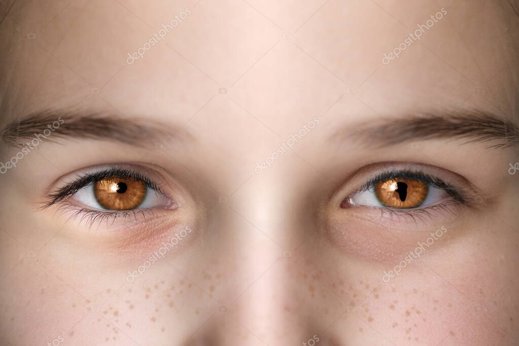 colaboma congénito de iris, mancha negra en forma de pera, anomalías ...