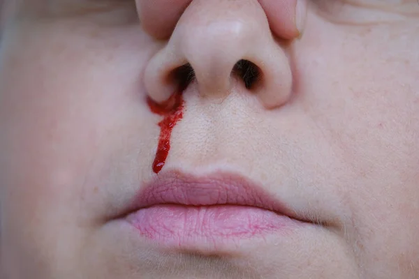 Imágenes de Epistaxis libres de derechos | Depositphotos