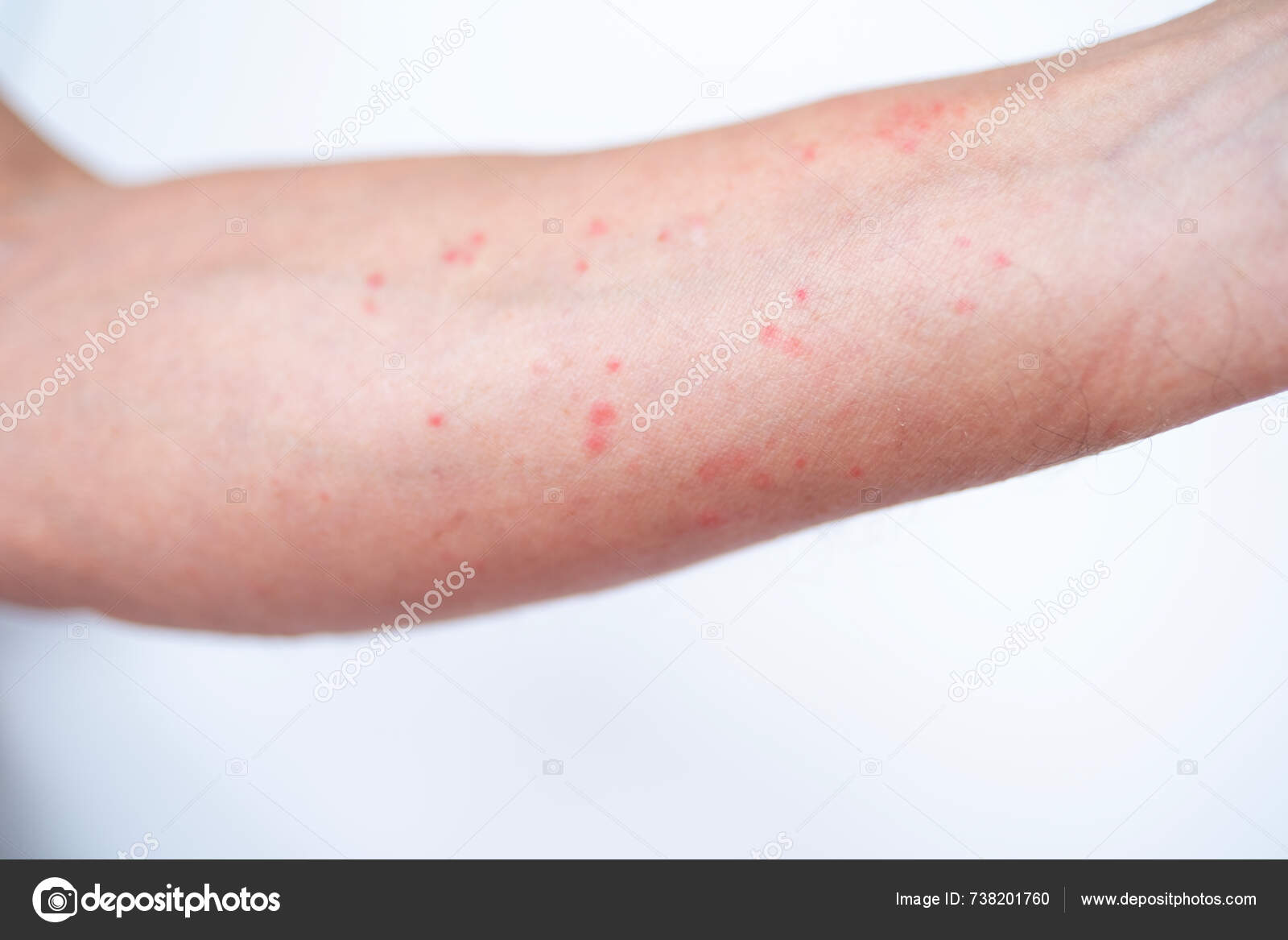 Allergic Rash Inflamed Skin Red Spots Man's Arm Dermatitis Allergic ...