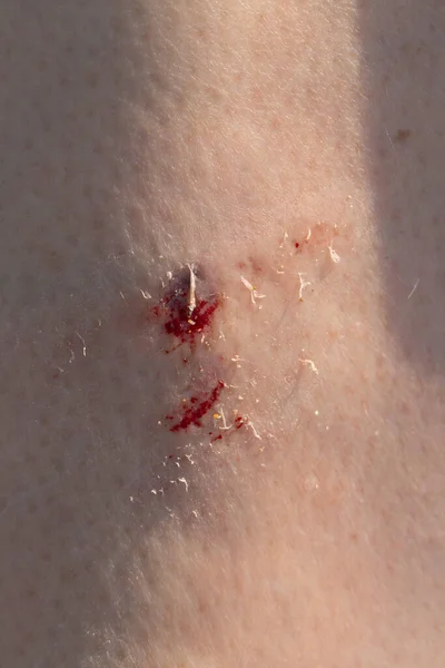 Scratch wound Stock Photos, Royalty Free Scratch wound Images ...