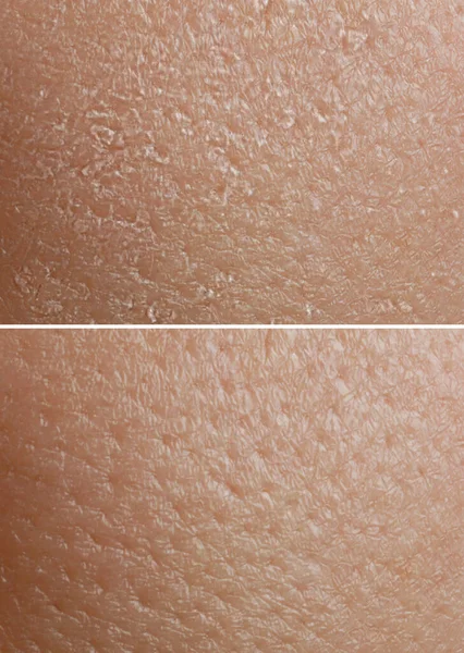 Collage Demonstrating Comparison Dry Moisturized Human Skin Closeup ...