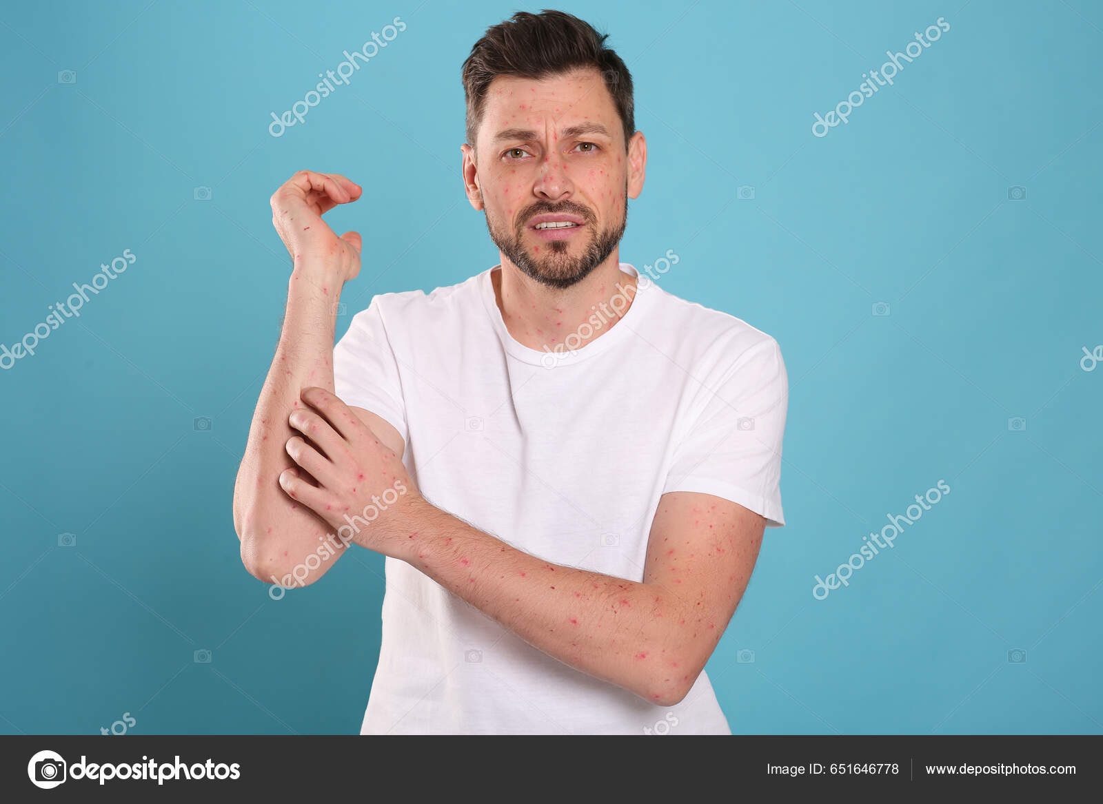 Hombre Con Erupción Que Sufre Virus Viruela Sobre Fondo Azul ...