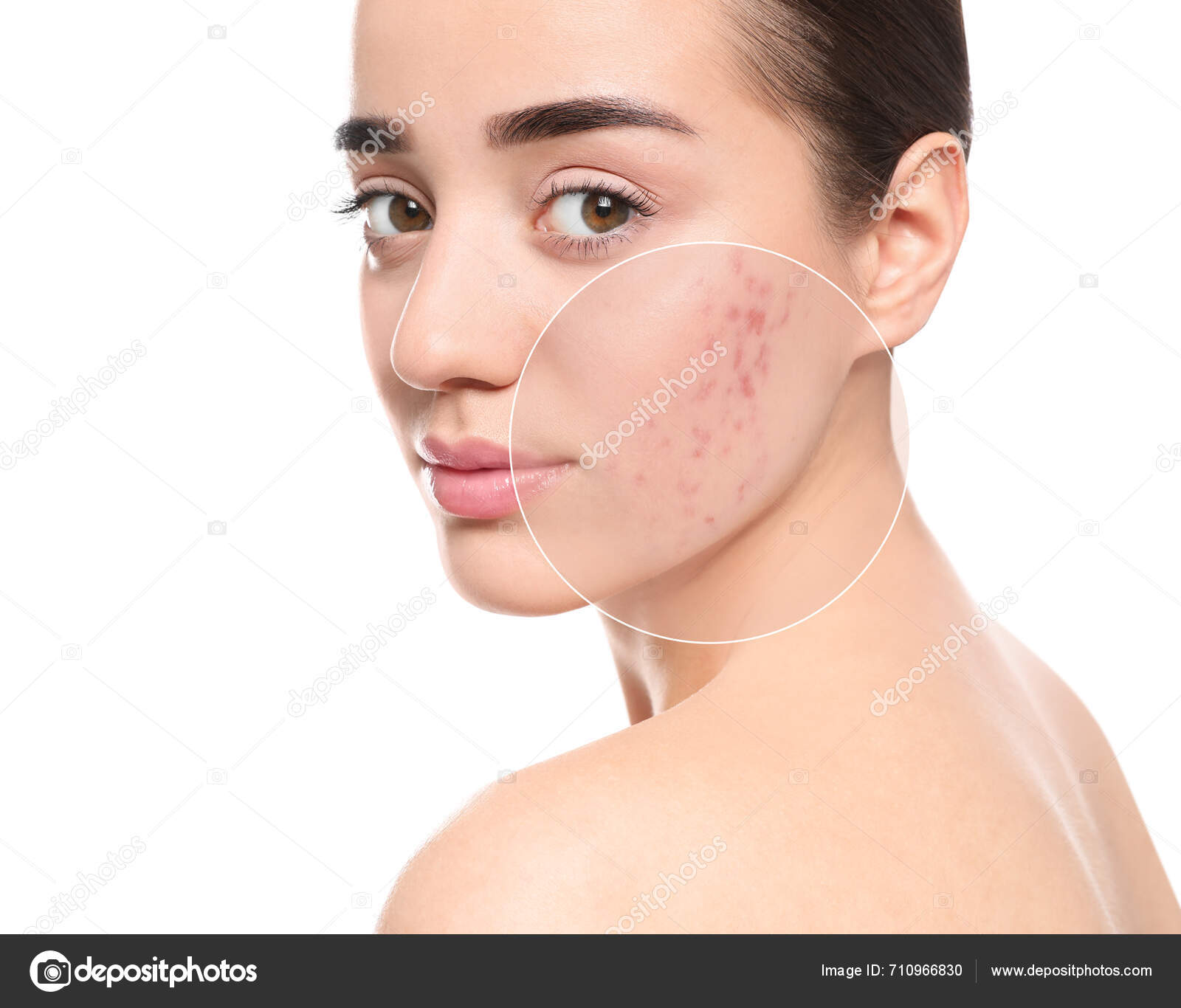 Mulher Com Acne Rosto Fundo Branco Área Zoomed Mostrando Problema ...