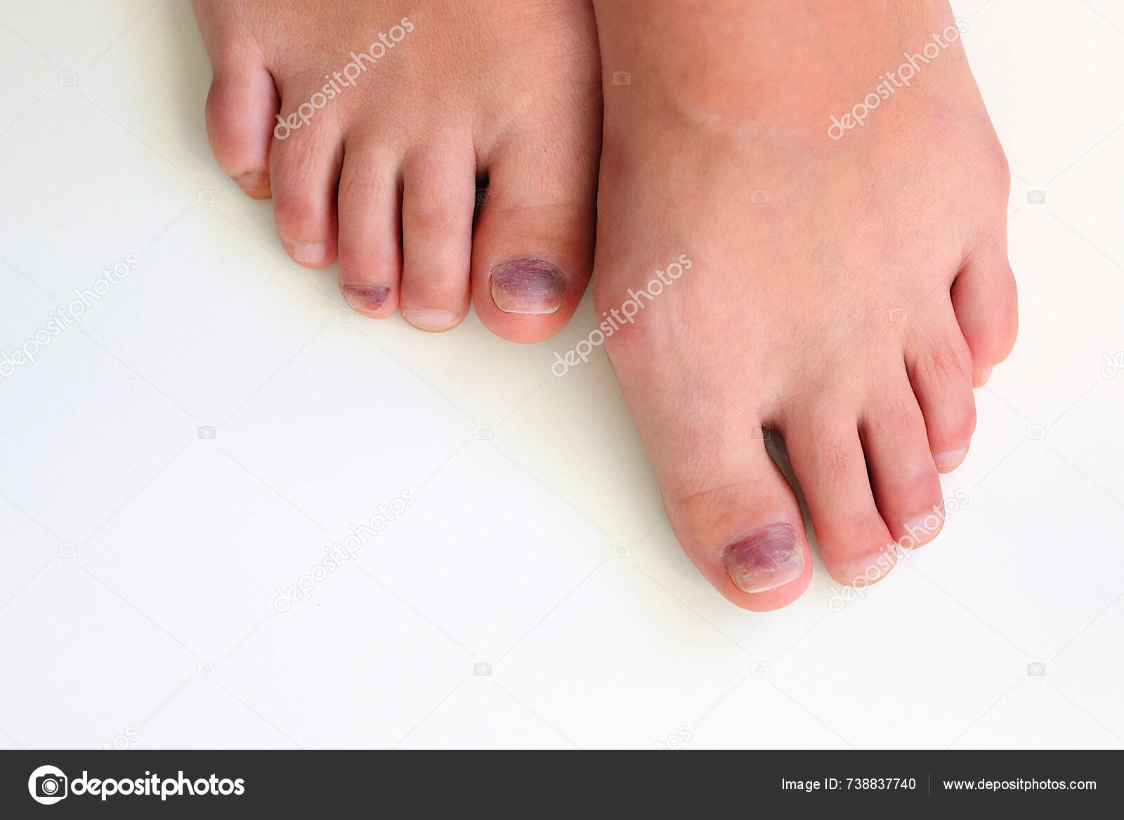 Toenails Bruise Hiking Injured Nails Body Trauma — Stock Photo ...
