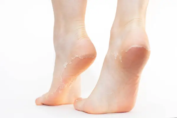 Rear Close View Female Feet Peeling Soles Skin Heels White — Stock ...