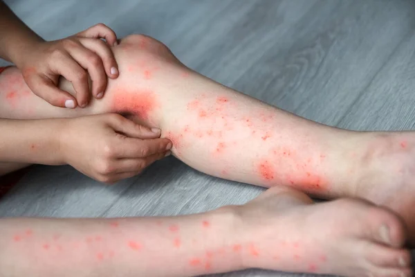 Atopic Dermatitis Legs Child Treatment — Stock Photo © Kostia777 #707327496