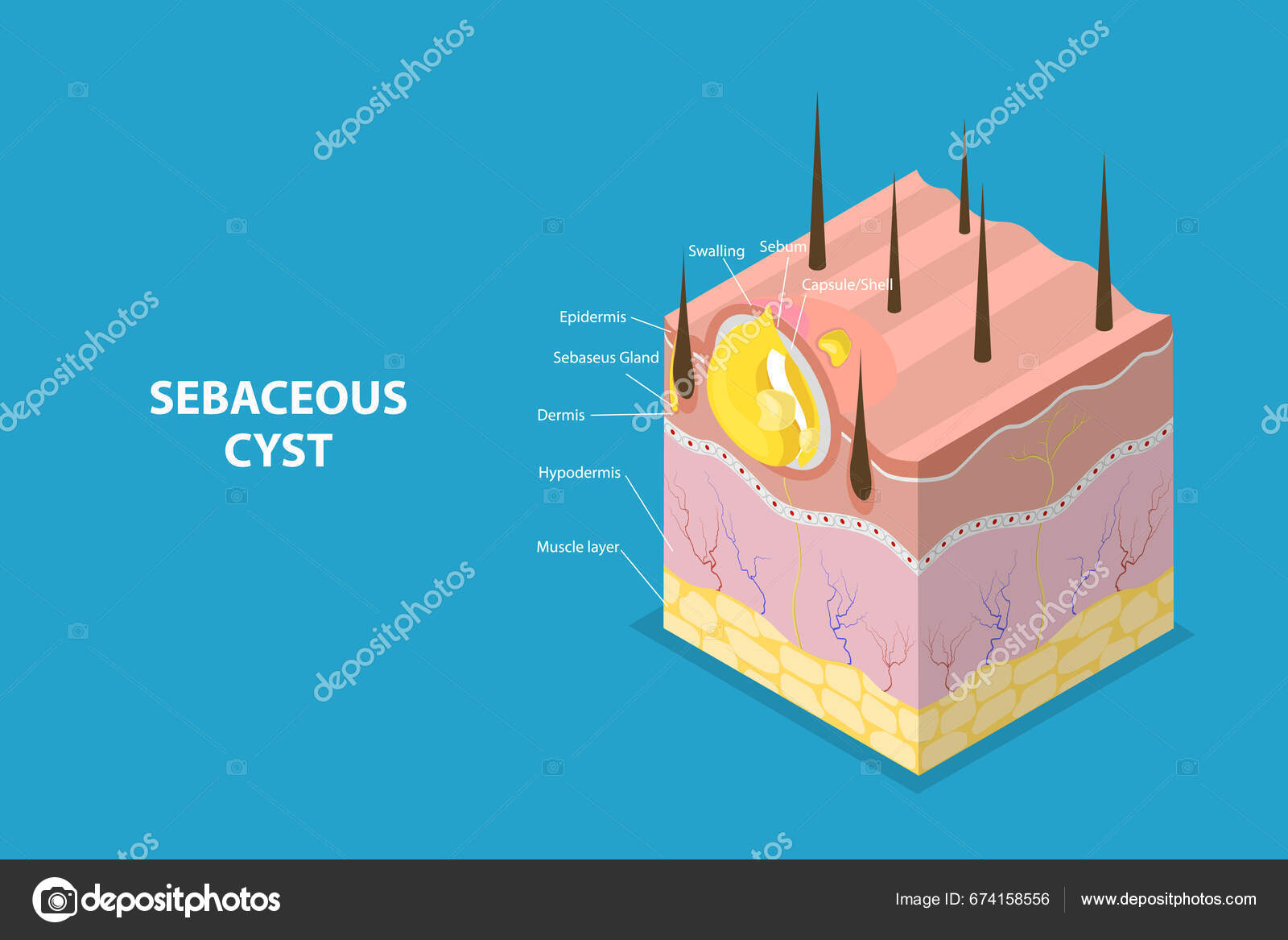 Sebaceous Cyst Diagram