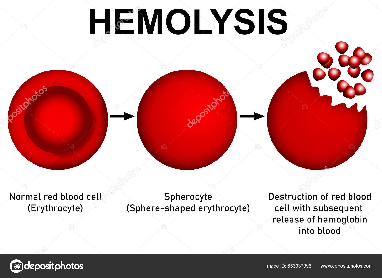 Diagrama Científico Proceso Hemólisis Representación — Foto de stock ...