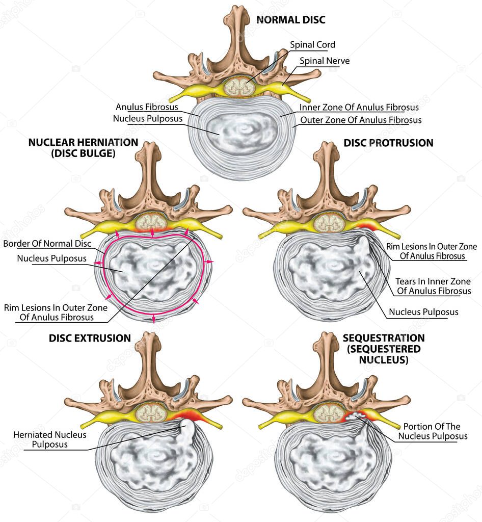 Nervios, tipos y etapas de la hernia discal lumbar, hernia discal ...