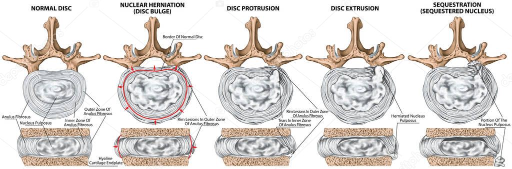 Disc protrusion Stock Photos, Royalty Free Disc protrusion Images ...