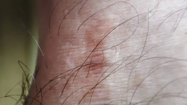 Dog bite scars Stock Photos, Royalty Free Dog bite scars Images ...