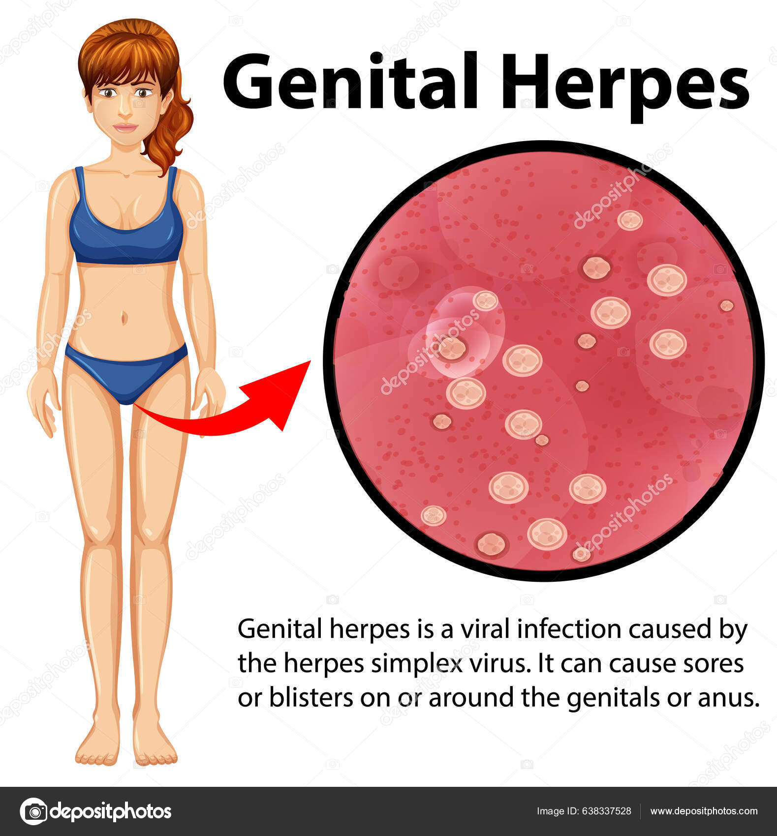 Genital Herpes Infographic Explanation Illustration Stock Vector by ... Genital Herpes Infographic Explanation Illustration Stock Vector by ...