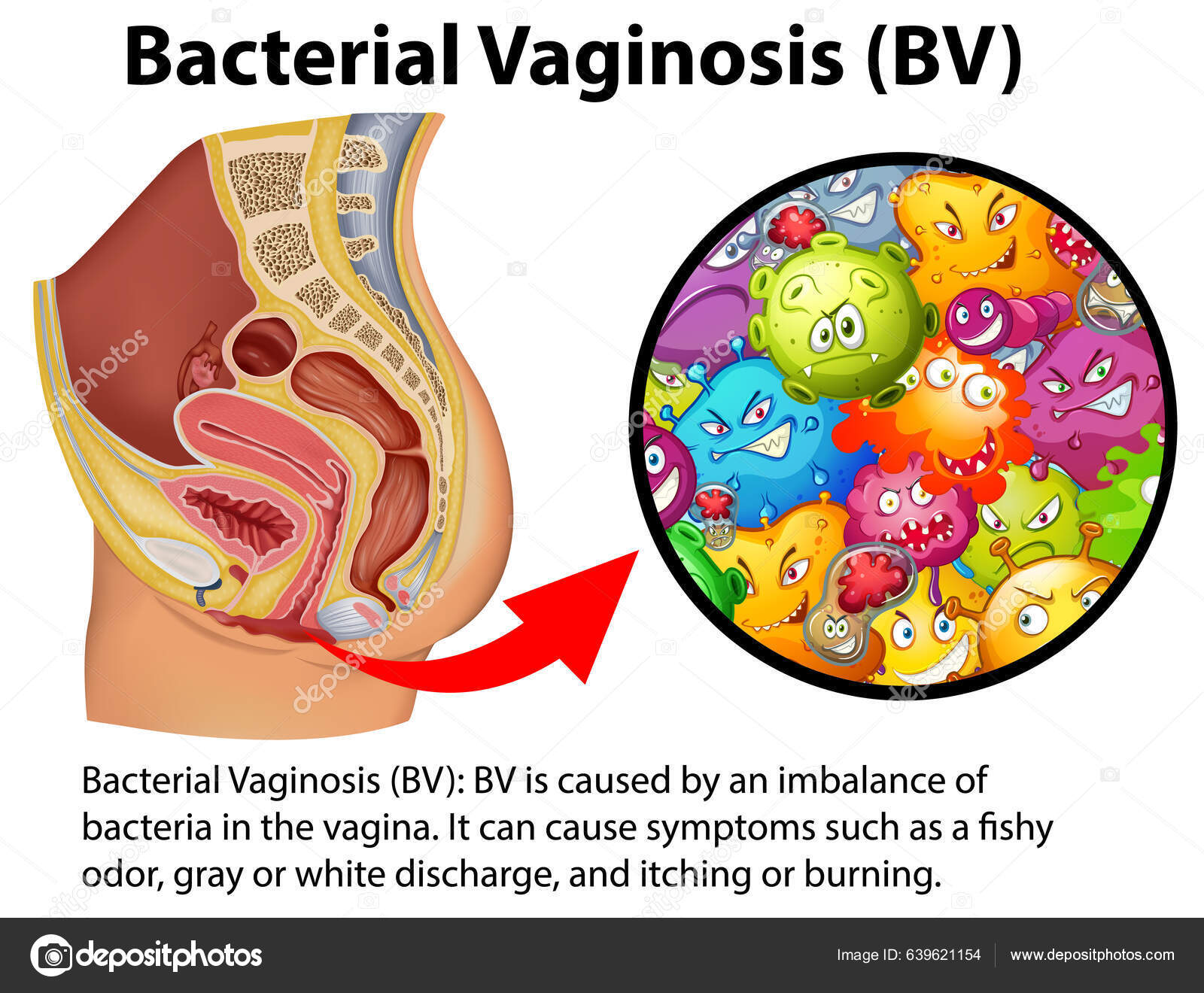Bacterial Vaginosis Infographic Explanation Illustration Vector de stock #639621154 de ...
