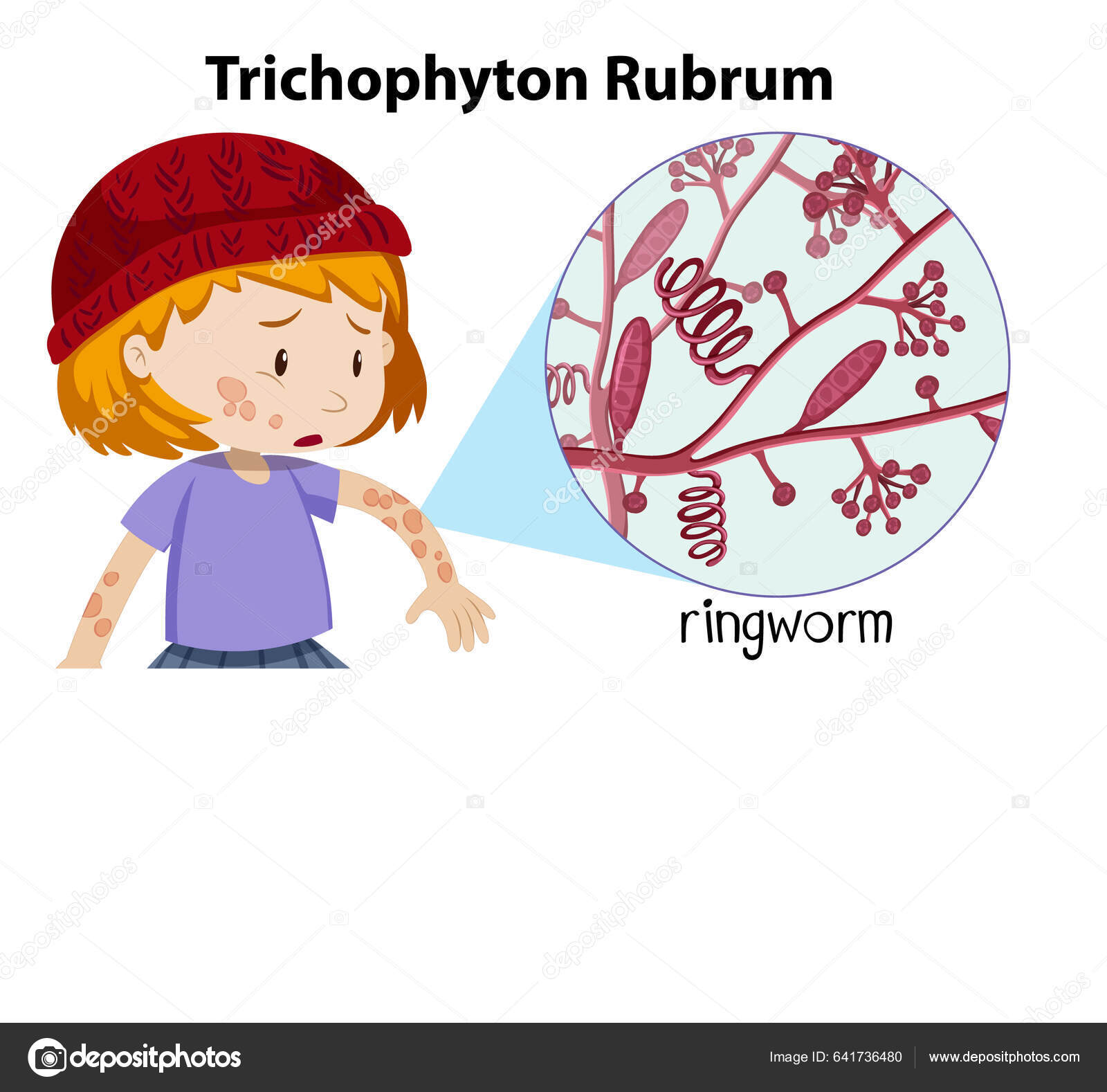 Trichophyton Rubrum Fungal Infection Illustration Stock Illustration by ...