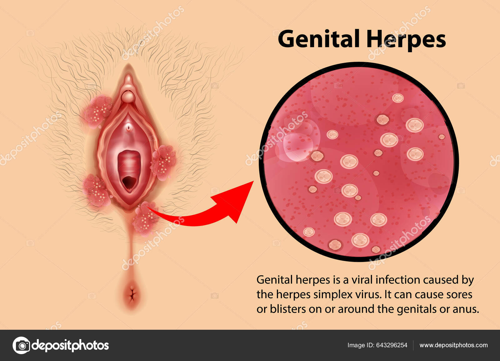 Diagrama De Estrutura Do Virus Herpes
