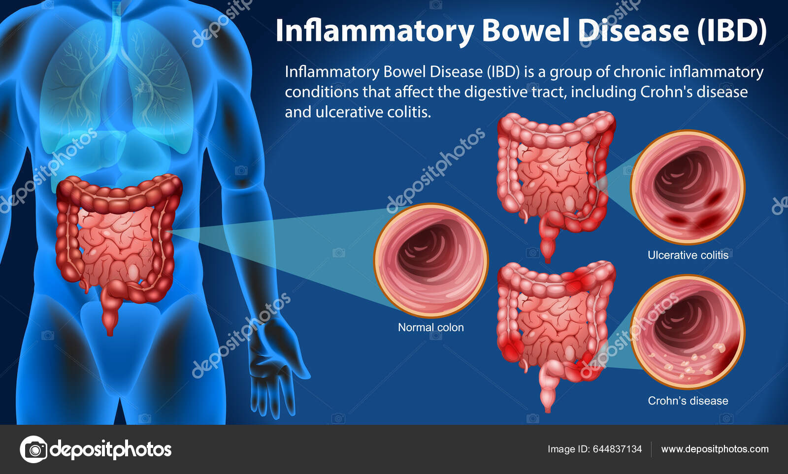 Ilustrasi Infografis Penyakit Kejiwaan Ibd Vektor Stok oleh ...