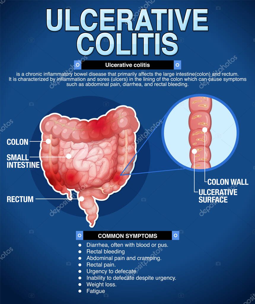 Colitis Ulcerosa Síntomas Infografía Ilustración Vector de Stock de ...