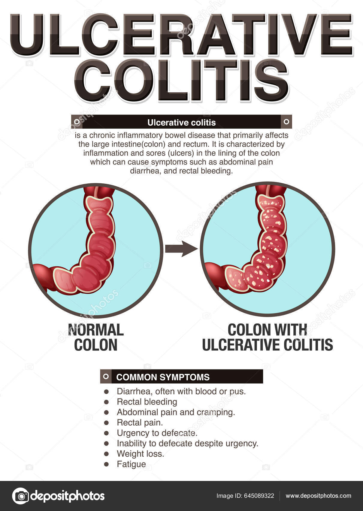 Colitis Ulcerosa Síntomas Infografía Ilustración Stock Vector By