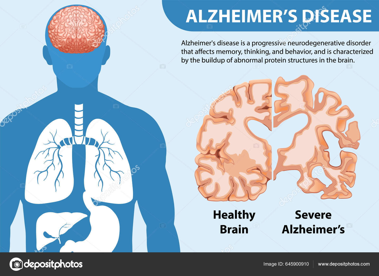 Cartel Informativo Enfermedad Alzheimers Ilustración Vector de stock ...