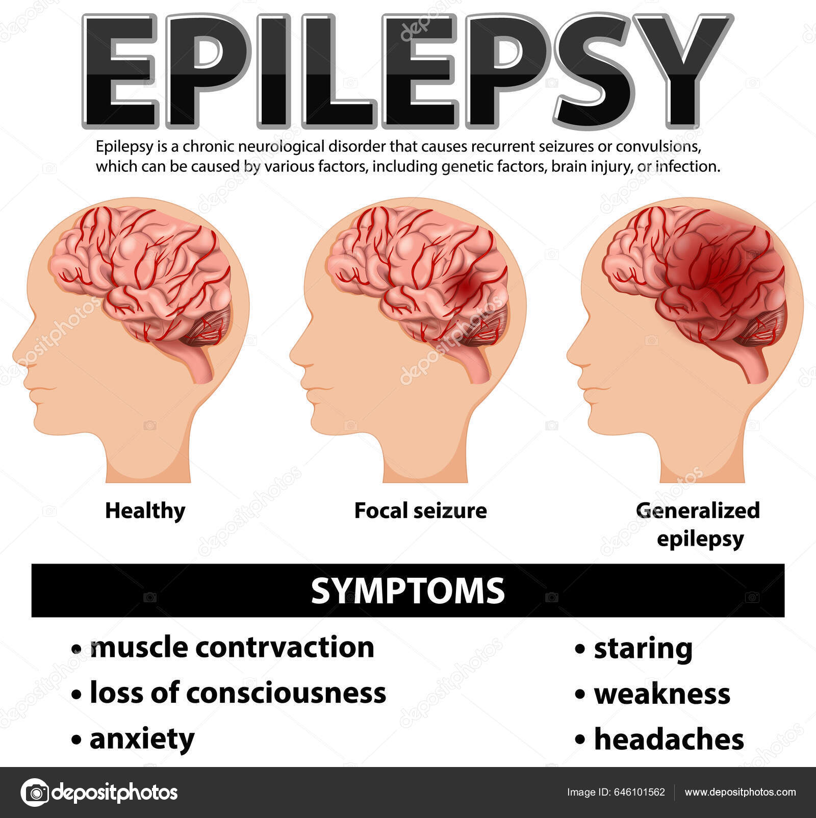 Cartel Informativo Epilepsia Ilustración Stock Vector by ©blueringmedia ...