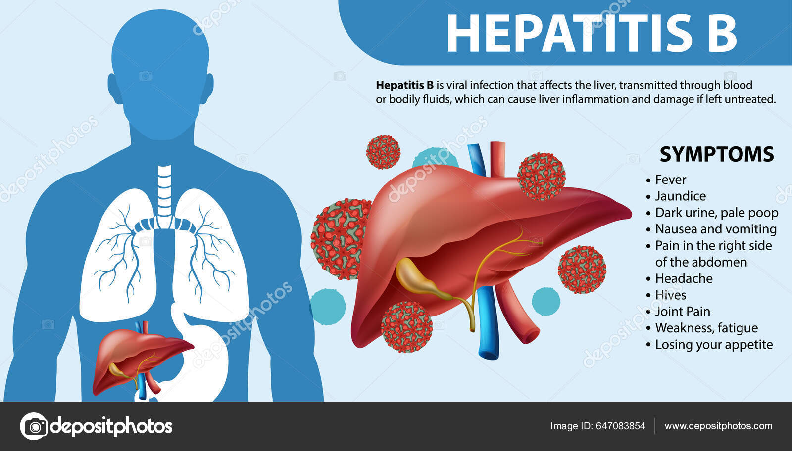 Síntomas Hepatitis Ilustración Infográfica Vector de stock #647083854 de ©blueringmedia