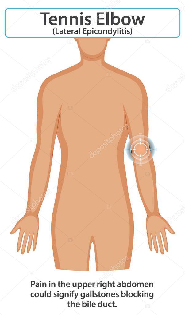Diagrama que muestra la ubicación del dolor de codo de tenista 2025