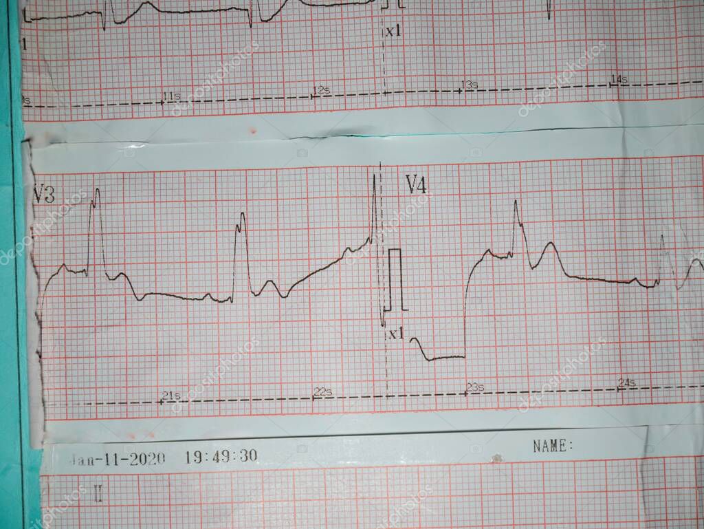 an electrocardiogram or ecg picture that describes a heart rhythm ...