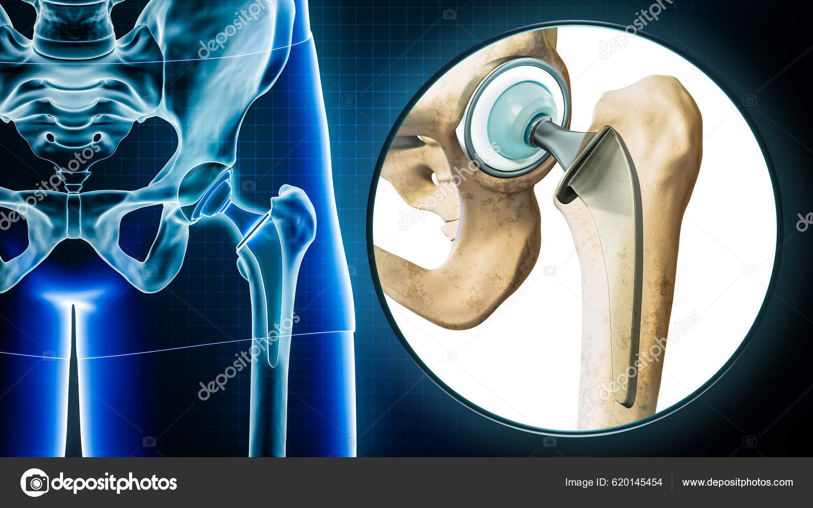Prótesis Cadera Cabeza Femoral Radiografía Implante Con Aumento Primer ...