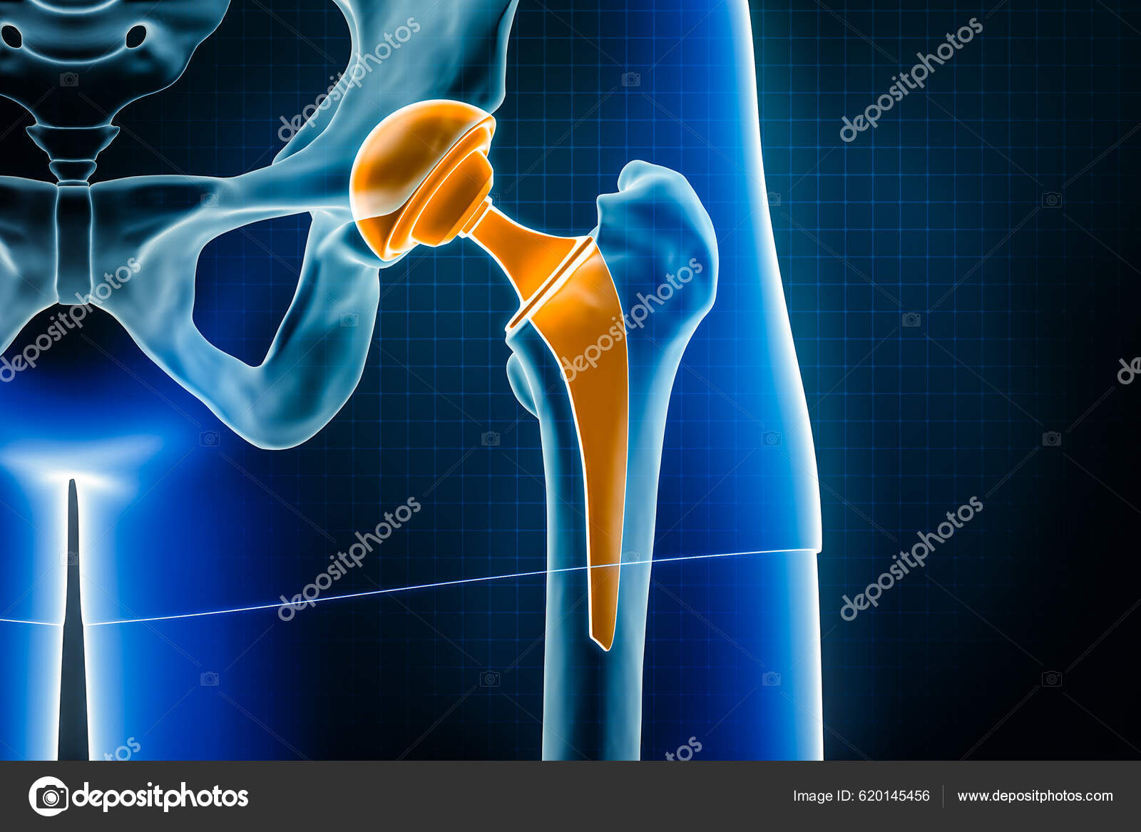 Hip Prosthesis Ray Rendering Illustration Total Hip Joint Replacement ...
