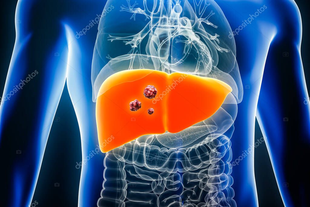 Liver cancer with organs and tumors or cancerous cells 3D rendering ...