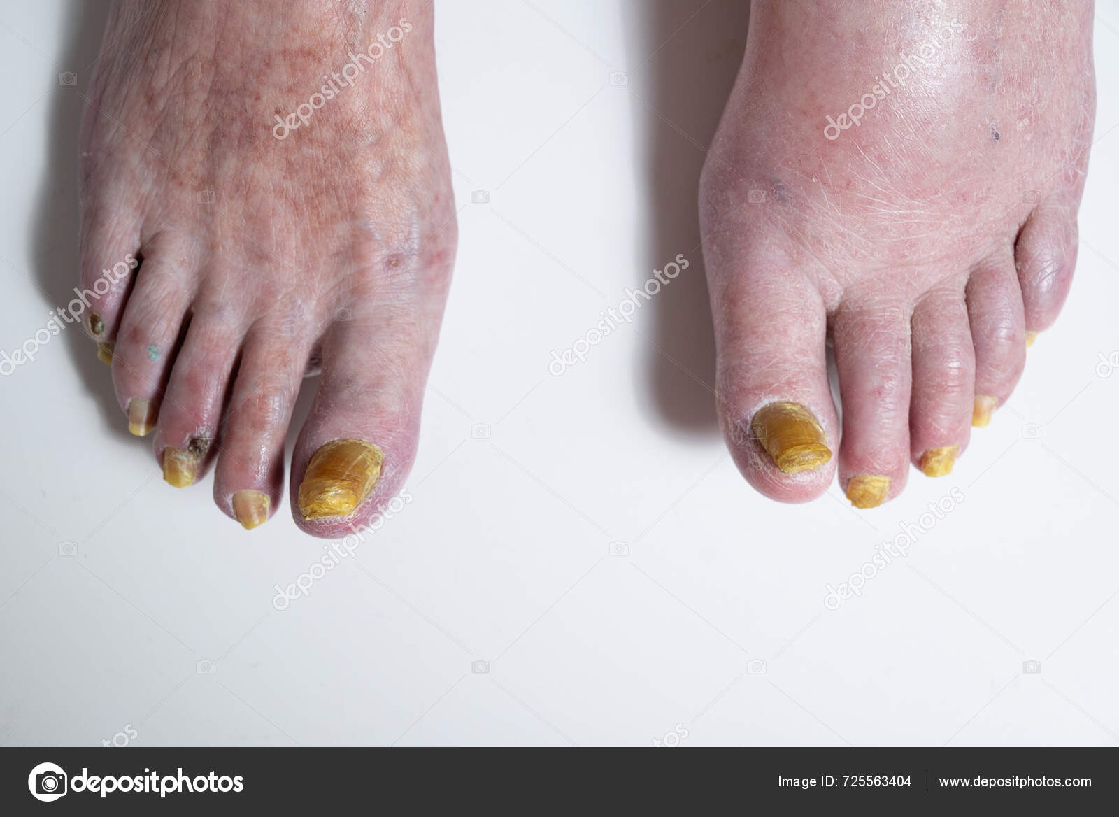 Elderly Woman Foot Damaged Nails Because Fungus Leg Vein Thrombosis ...