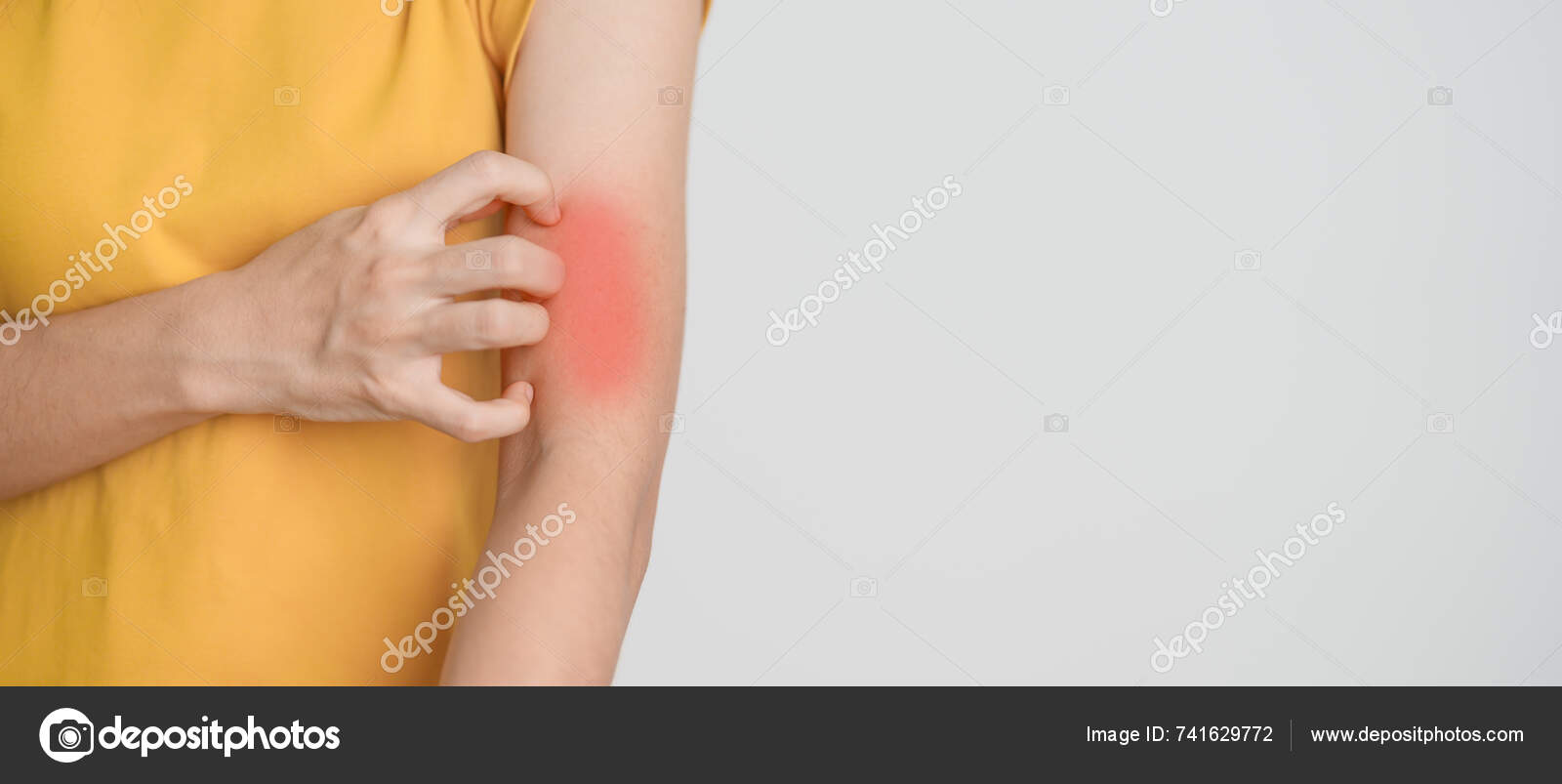 Woman Itching Scratching Itchy Arm Sensitive Skin Allergic Reaction ...