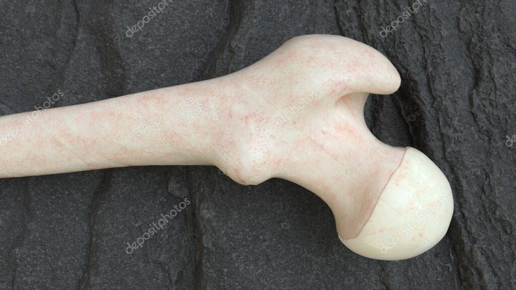 osteoporosis huesos del muslo desde el exterior - 3d renderizado 2024