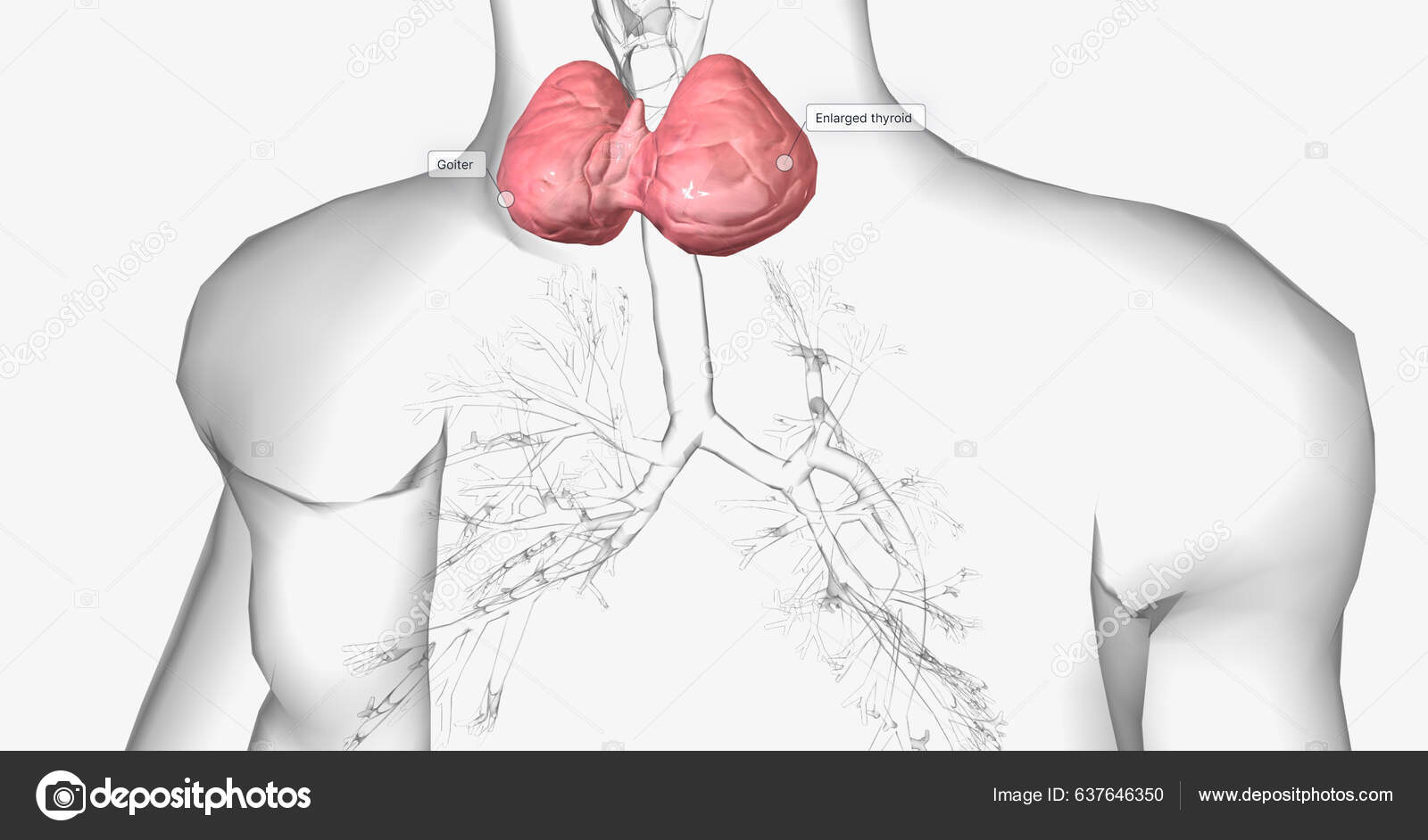 Goiter Swollen Rounded Lump Throat Caused Abnormal Enlargement Thyroid ...