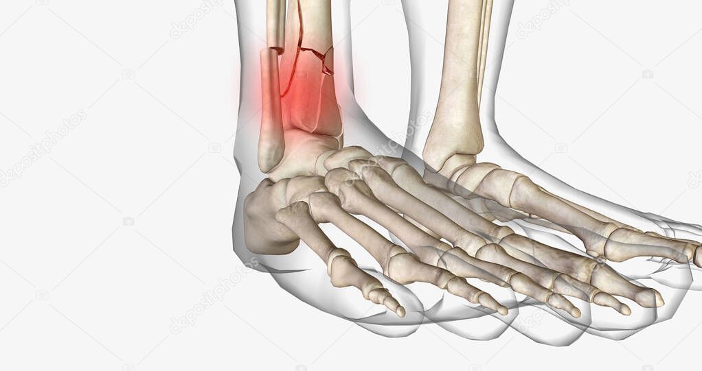 Las fracturas distales de tibia afectan la articulación del tobillo y a ...