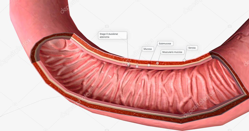 El carcinoma duodenal, representación en 3D de la etapa 0 2025