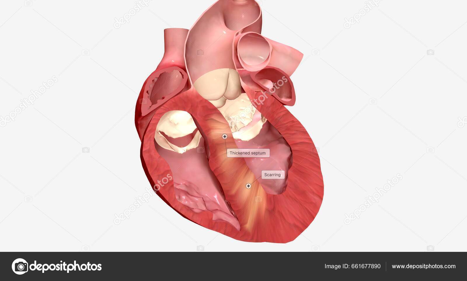 Hypertrophic Cardiomyopathy Occurs Muscle Cells Heart Enlarge Causing ...