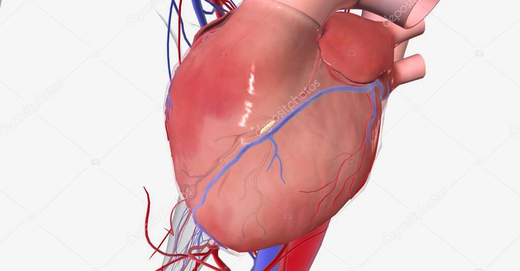 La isquemia miocárdica es causada por la reducción del flujo sanguíneo al corazón y la falta de ...