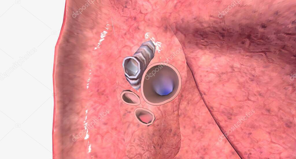 El hilio de cada pulmón se encuentra en el lado medial o mediastínico ...