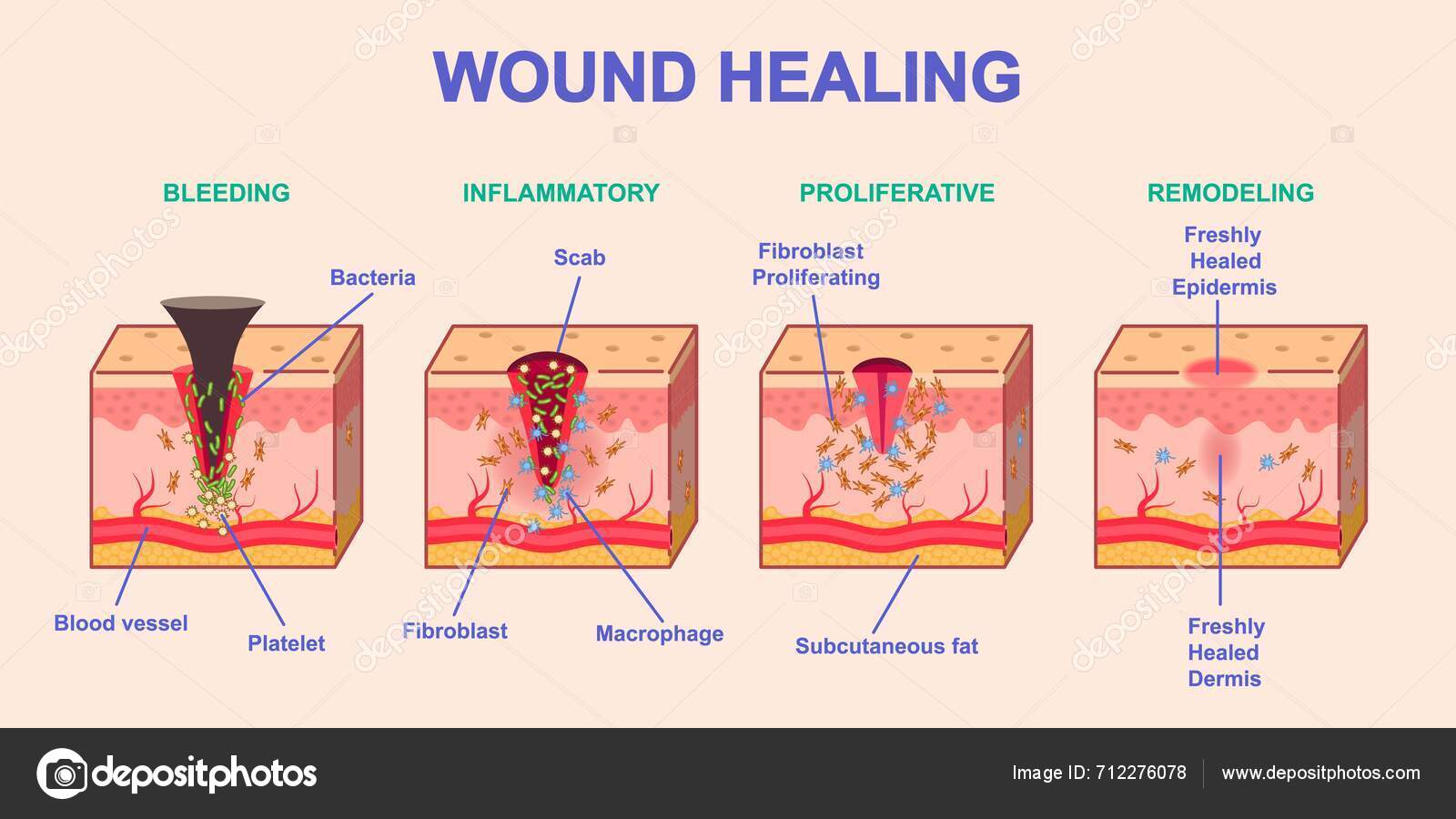 Wound Healing Process Medical Infographics Diagram Stages Phases Skin ...