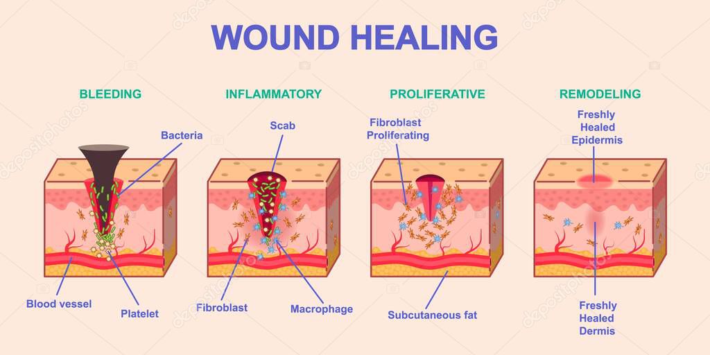 Proceso de curación de heridas. Infografías médicas o diagrama con etapas o fases de ...