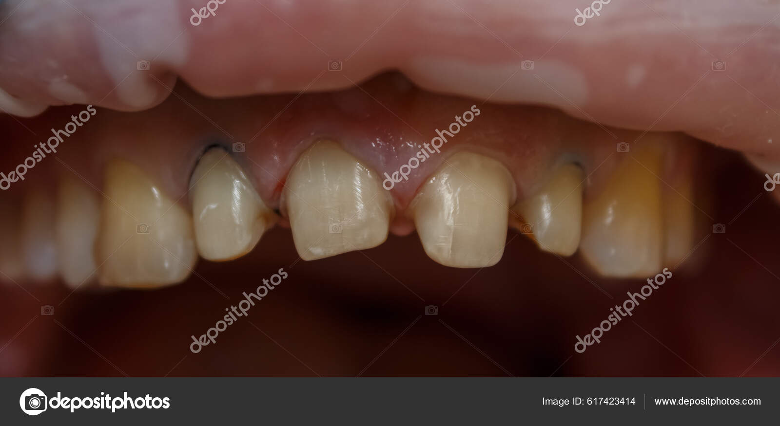 Preparation Prosthetic Teeth Teeth Treated Prosthetics Crowns ...