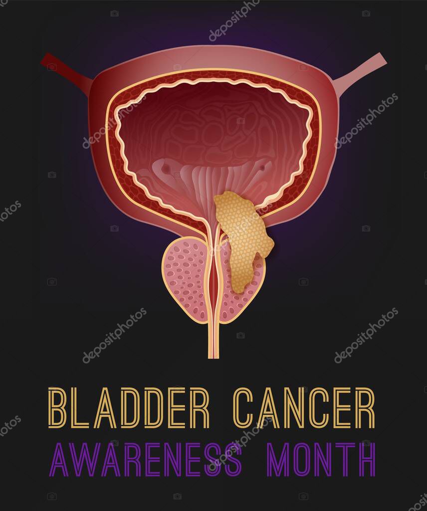 Cartel de retrato de carcinoma urotelial. Banner de c ncer de vejiga urinaria. Huella m dica ...