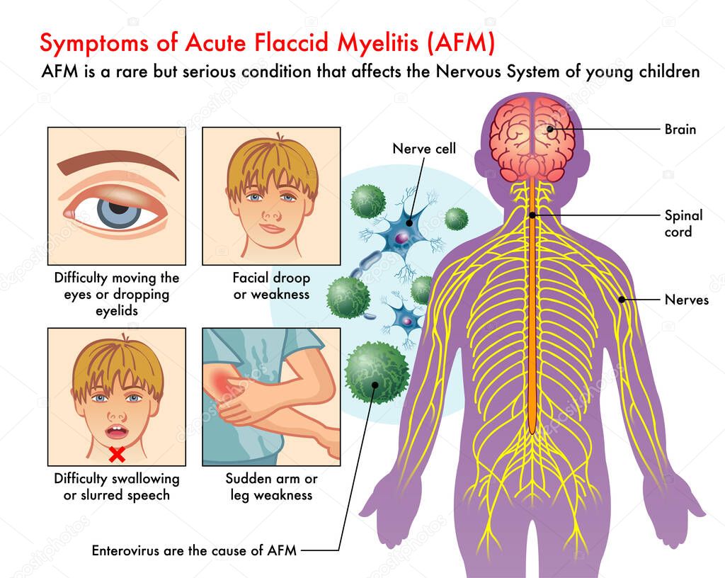 Ilustración médica de los síntomas de la mielitis flácida aguda, AFM ...